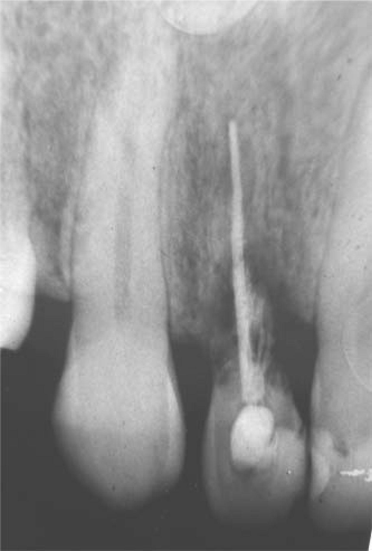 Reimplantación, anquilosis y sustitución con implante. Presentación de ...