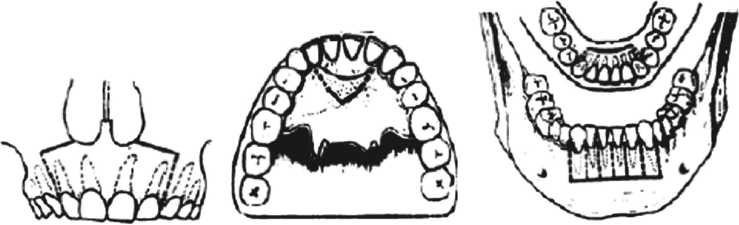 Corticotomy: historical perspective | Revista Odontológica Mexicana