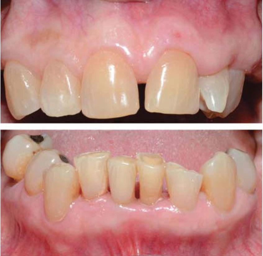 Gingival enlargement resolution by means of non-surgical periodontal ...