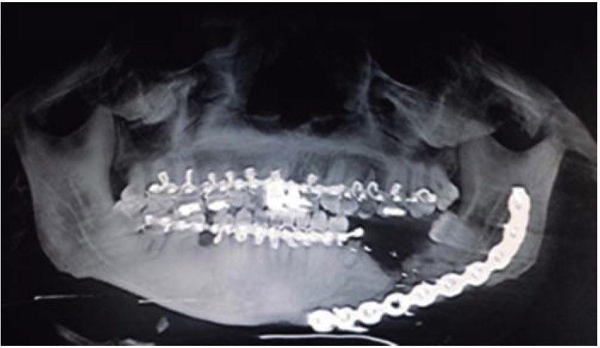 Gunshot caused facial wound. Literature review and clinical study of ...