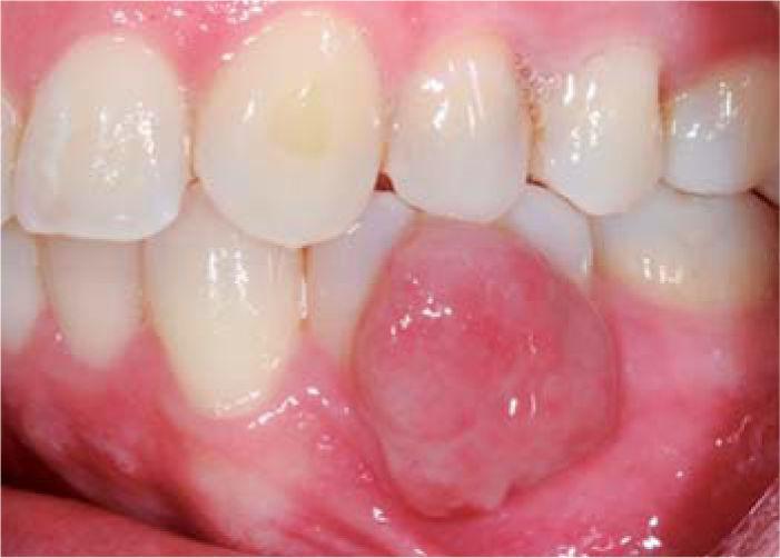 Oral pyogenic granuloma diagnosis and treatment: a series of cases ...