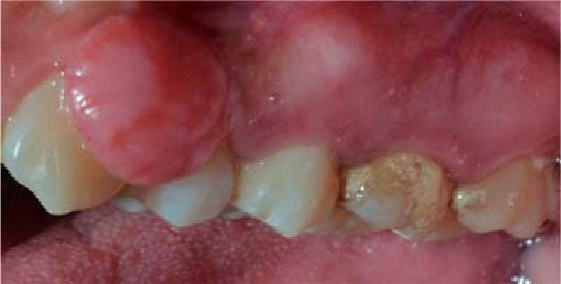 Oral pyogenic granuloma diagnosis and treatment: a series of cases ...