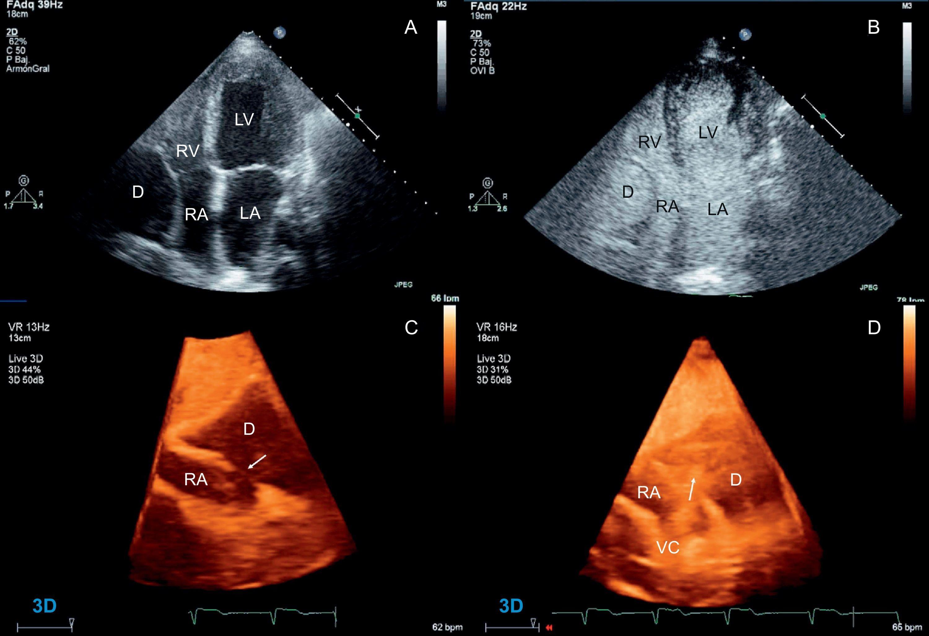 Giant Right Atrial Diverticulum: Utility of Contrast-enhanced ...