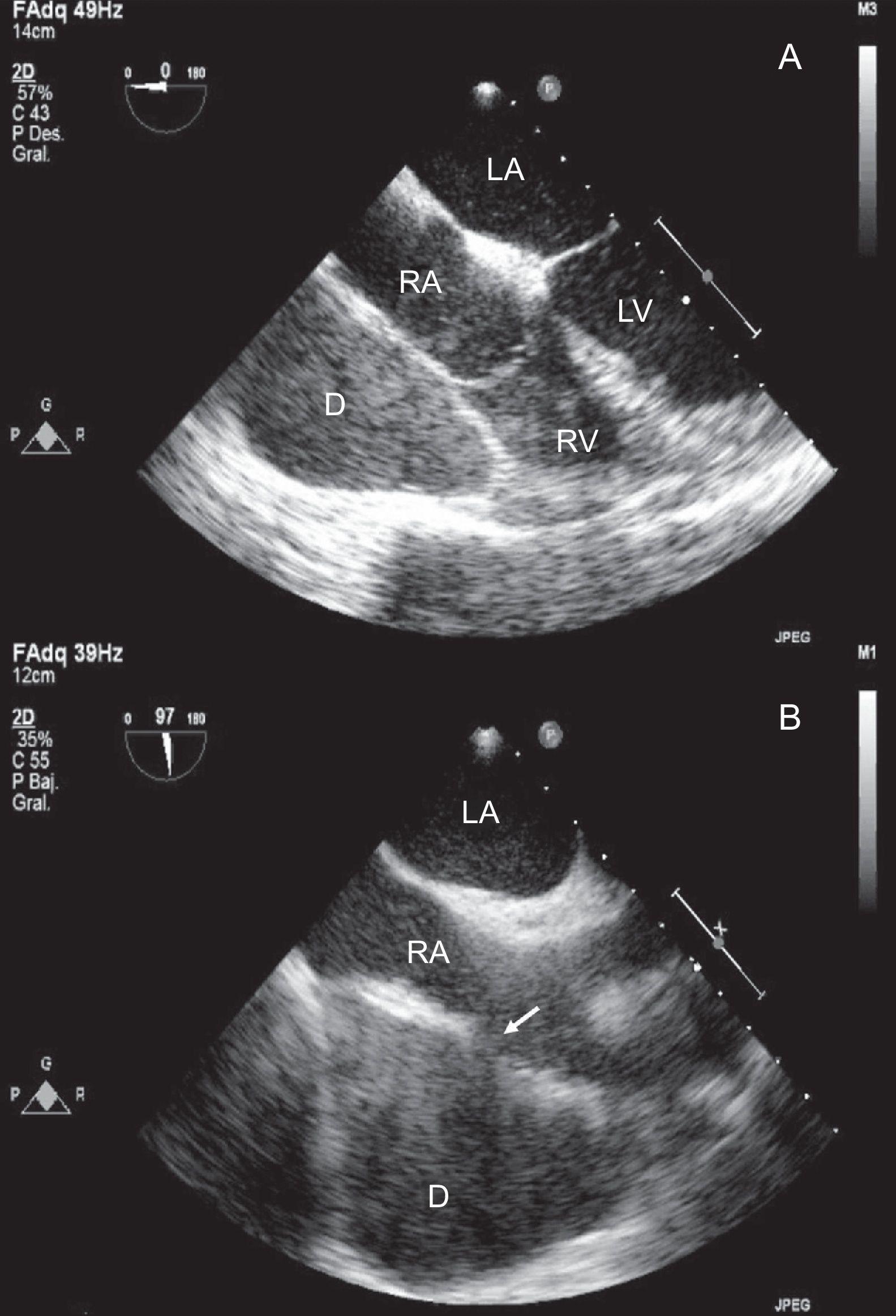 Giant Right Atrial Diverticulum: Utility of Contrast-enhanced ...