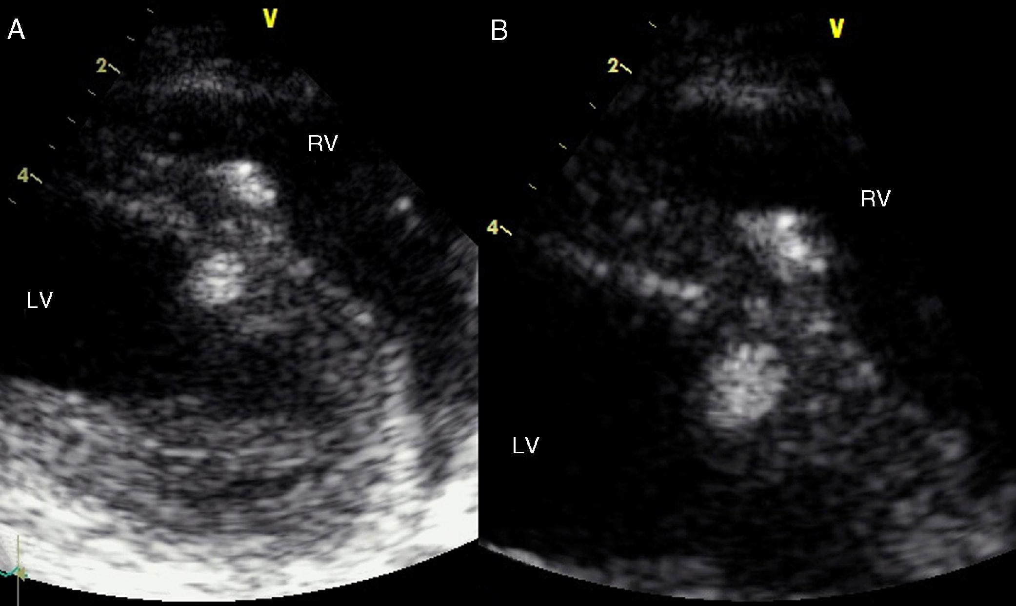 Cardiac Involvement in Tuberous Sclerosis | Revista Española de Cardiología