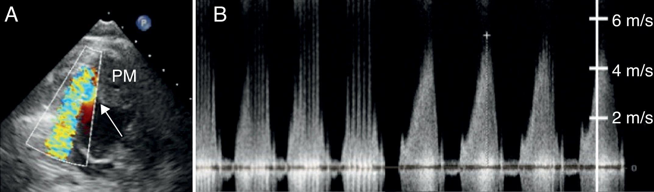 Vibration and Staccato Flow Pattern in Ventricular Assist Devices ...