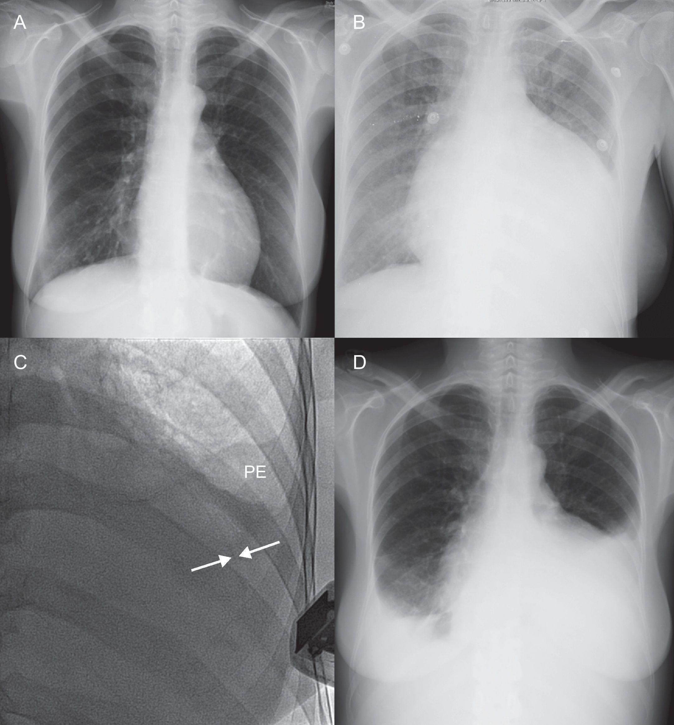 Percutaneous Balloon Pericardiotomy as the Initial and Definitive ...