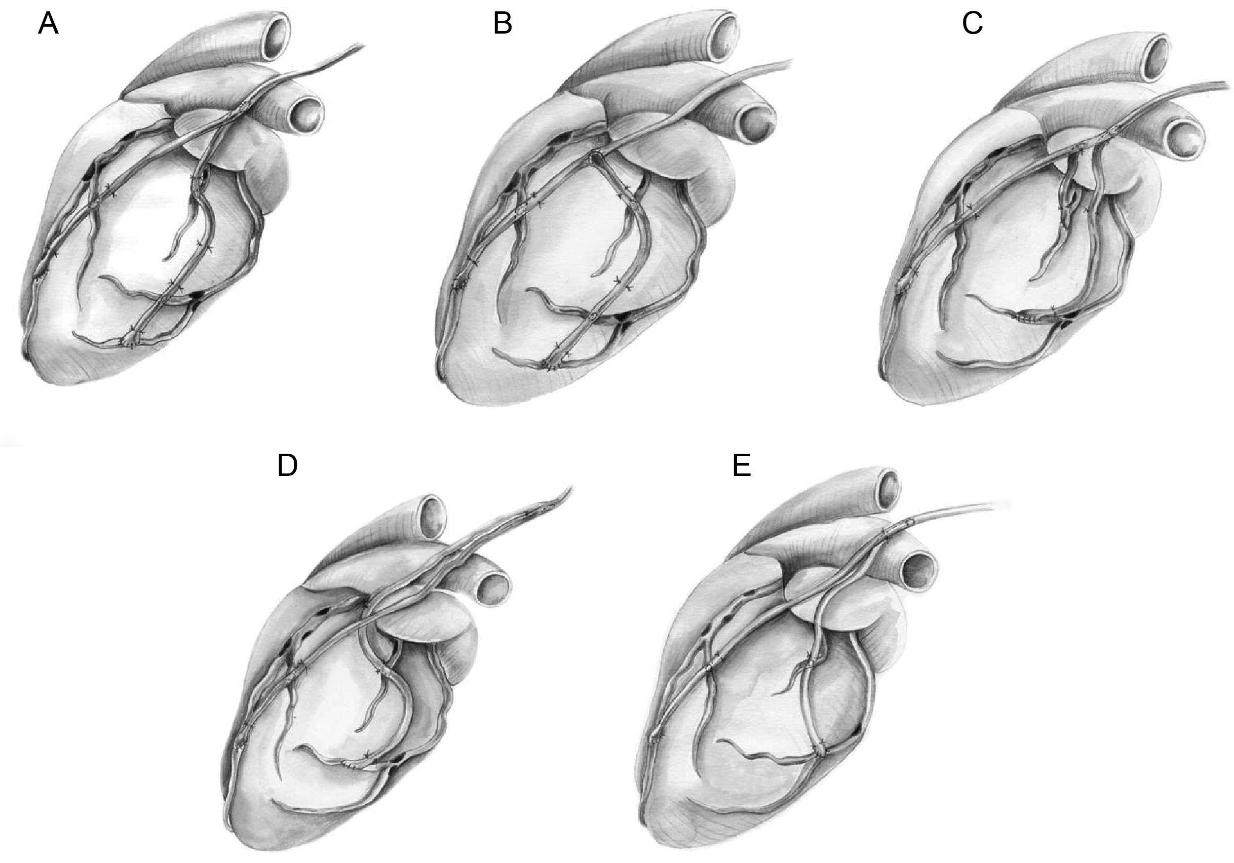 The Choice of the Second Graft | Revista Española de Cardiología
