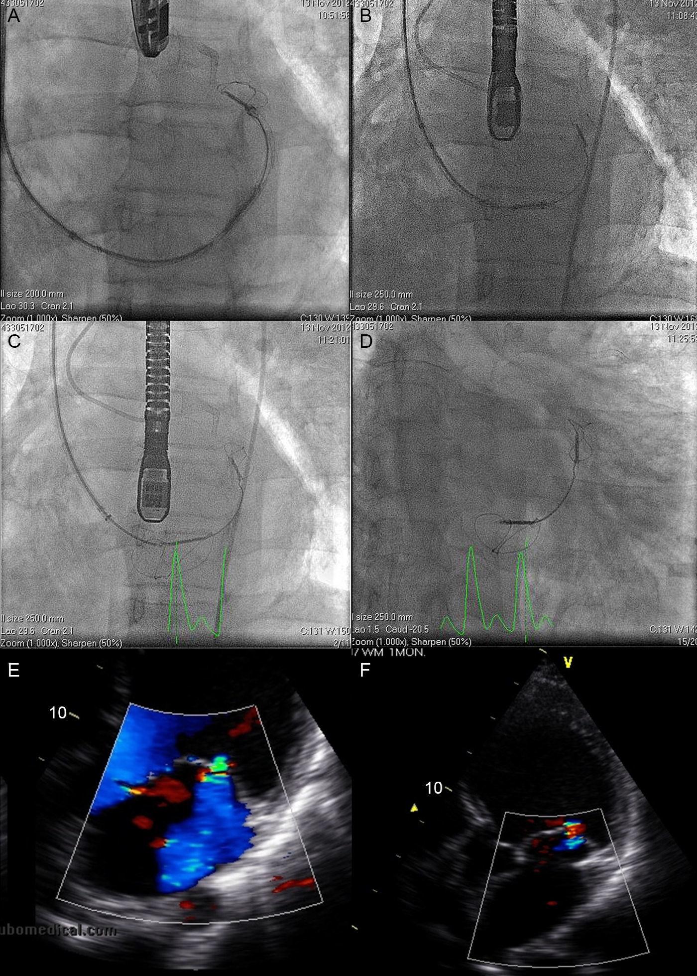 Advances in Percutaneous Treatment of Mitral Regurgitation | Revista ...