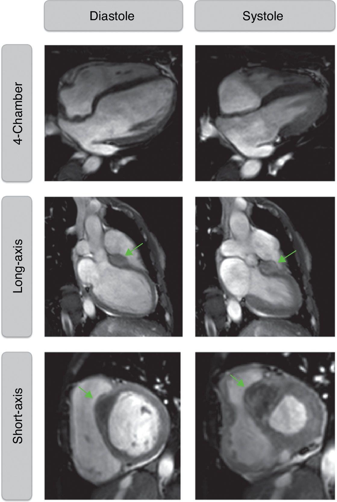 Comprehensive Assessment of Myocardial Fibroma by Cardiovascular ...