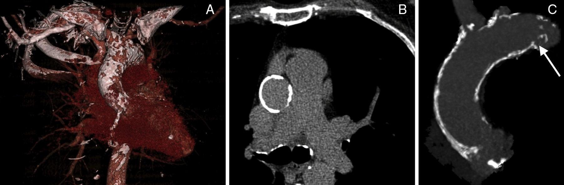 Porcelain Aorta and Severe Aortic Stenosis: Is Transcatheter Aortic ...