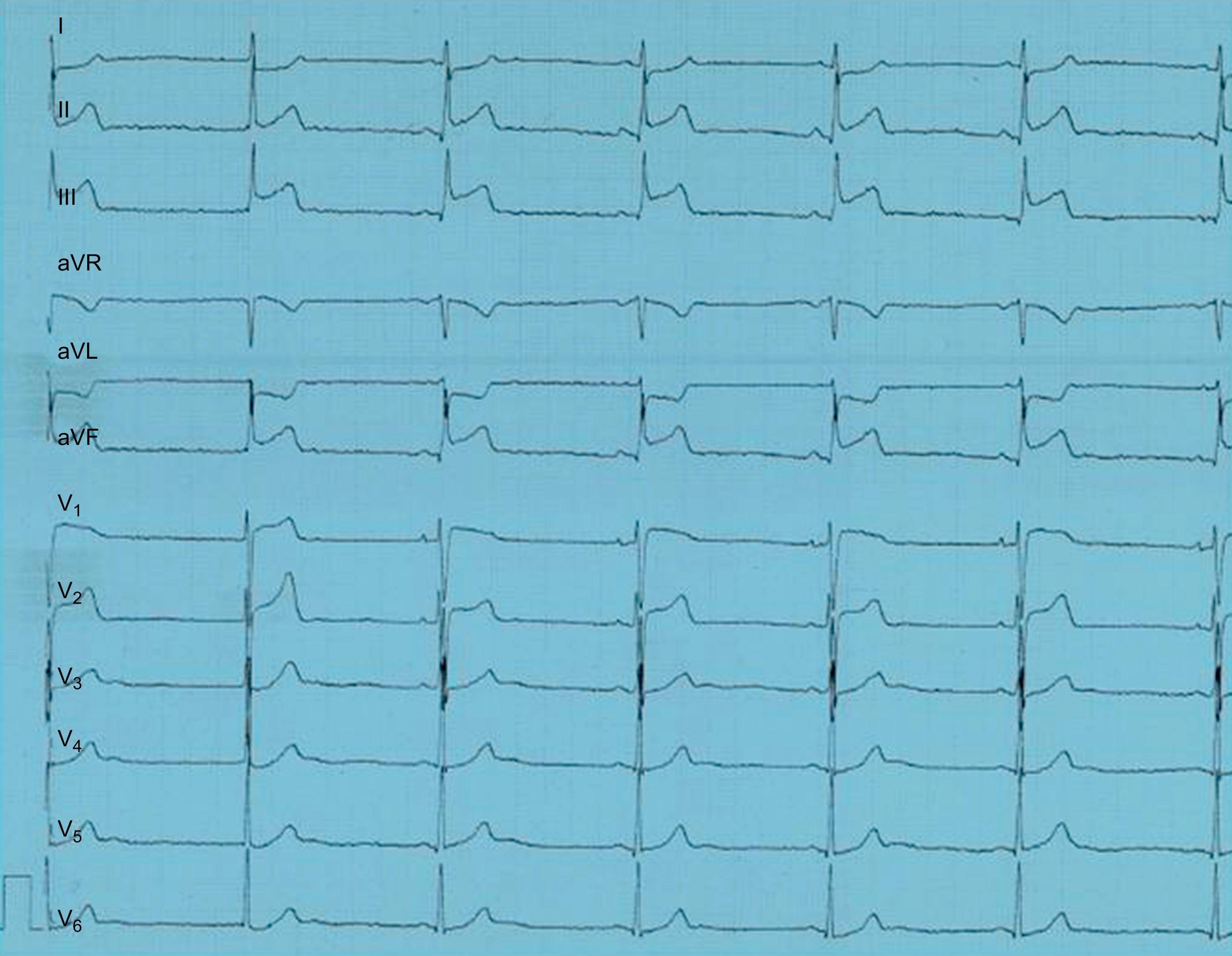 Chest Pain as the Predominant Symptom in Myocarditis in Children ...