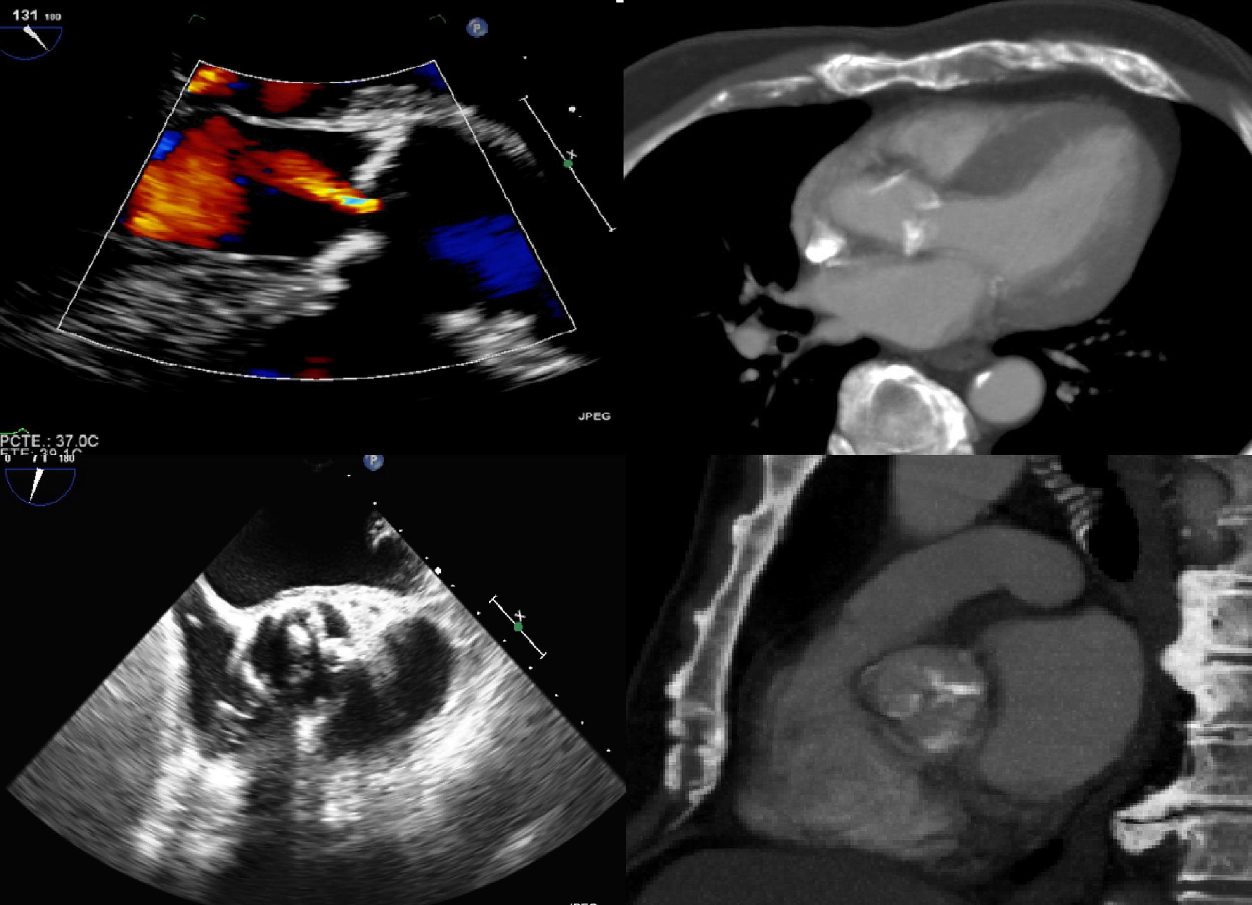 Aortic Valve Leaflets Echo
