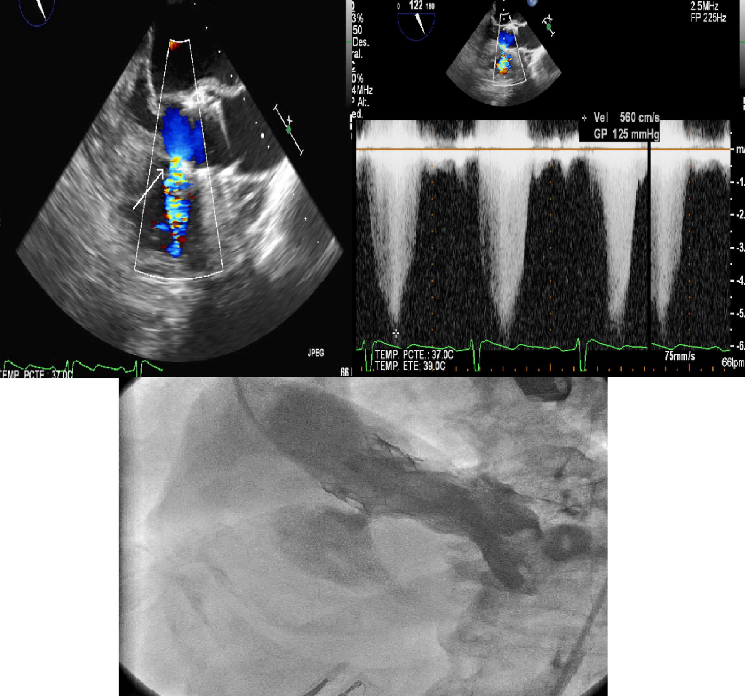 Ventricular Septal Defect as an Unusual Complication of Percutaneous ...