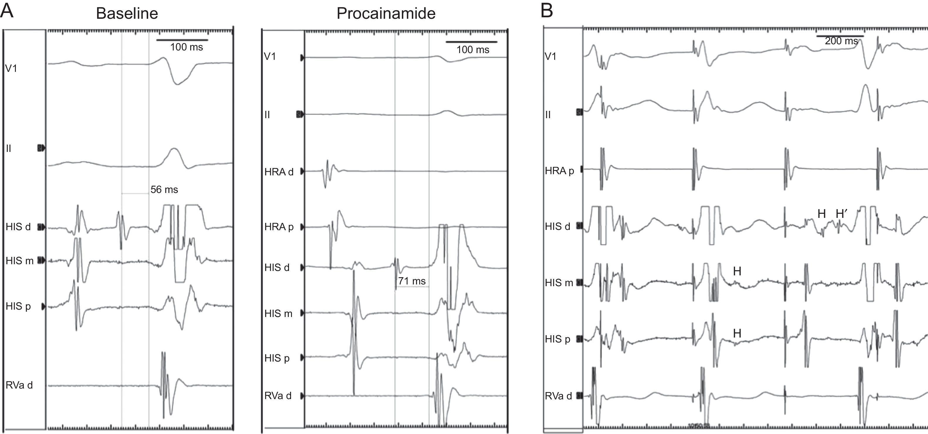 Infranodal Atrioventricular Block as a Possible Cause of Exercise ...