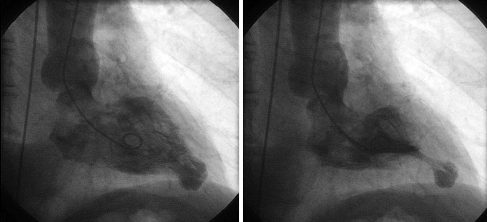 Diagnosis of Ventricular Diverticulum by Cardiac Computed Tomography ...