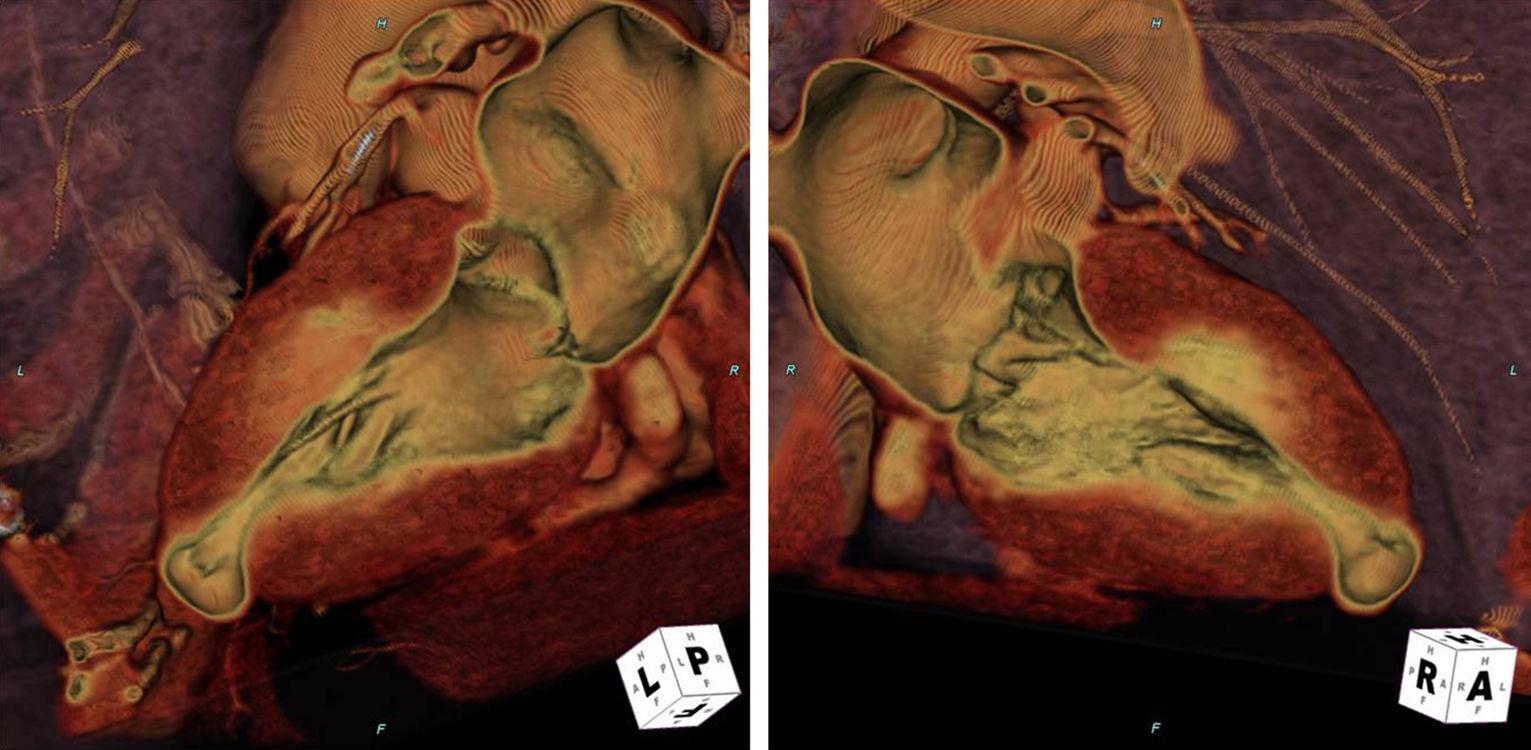 Diagnosis of Ventricular Diverticulum by Cardiac Computed Tomography ...