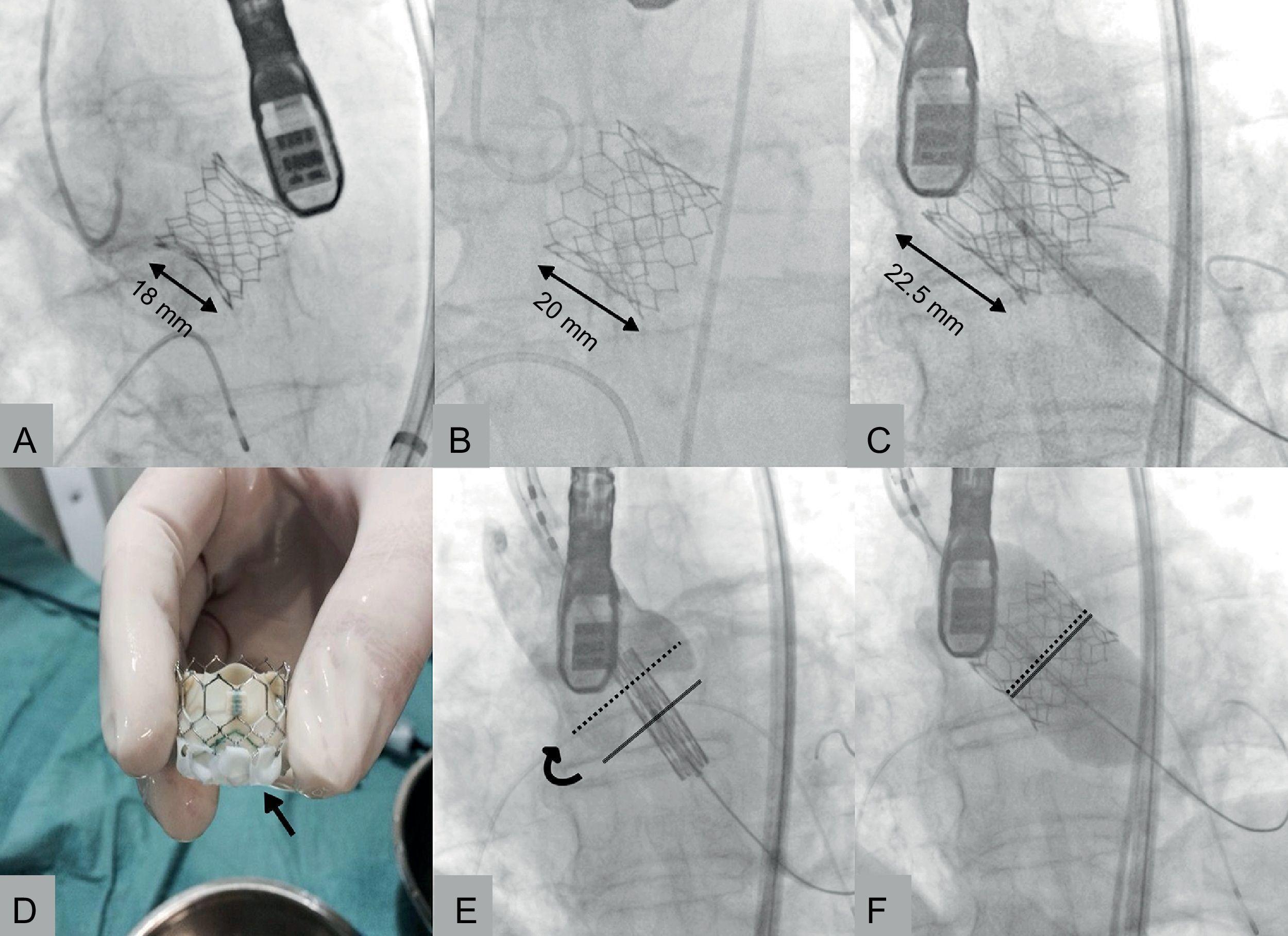 Initial Experience With the Low-profile Percutaneous Aortic Valve ...