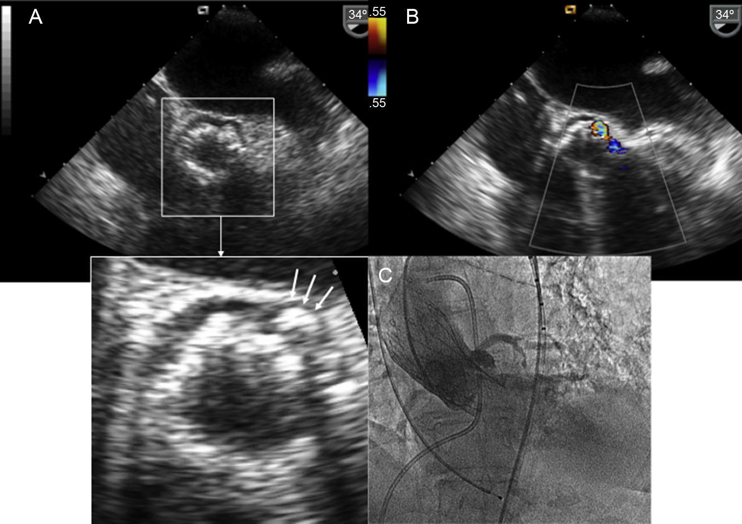 Next-generation Transcatheter Aortic Valves. An Opportunity to Expand ...