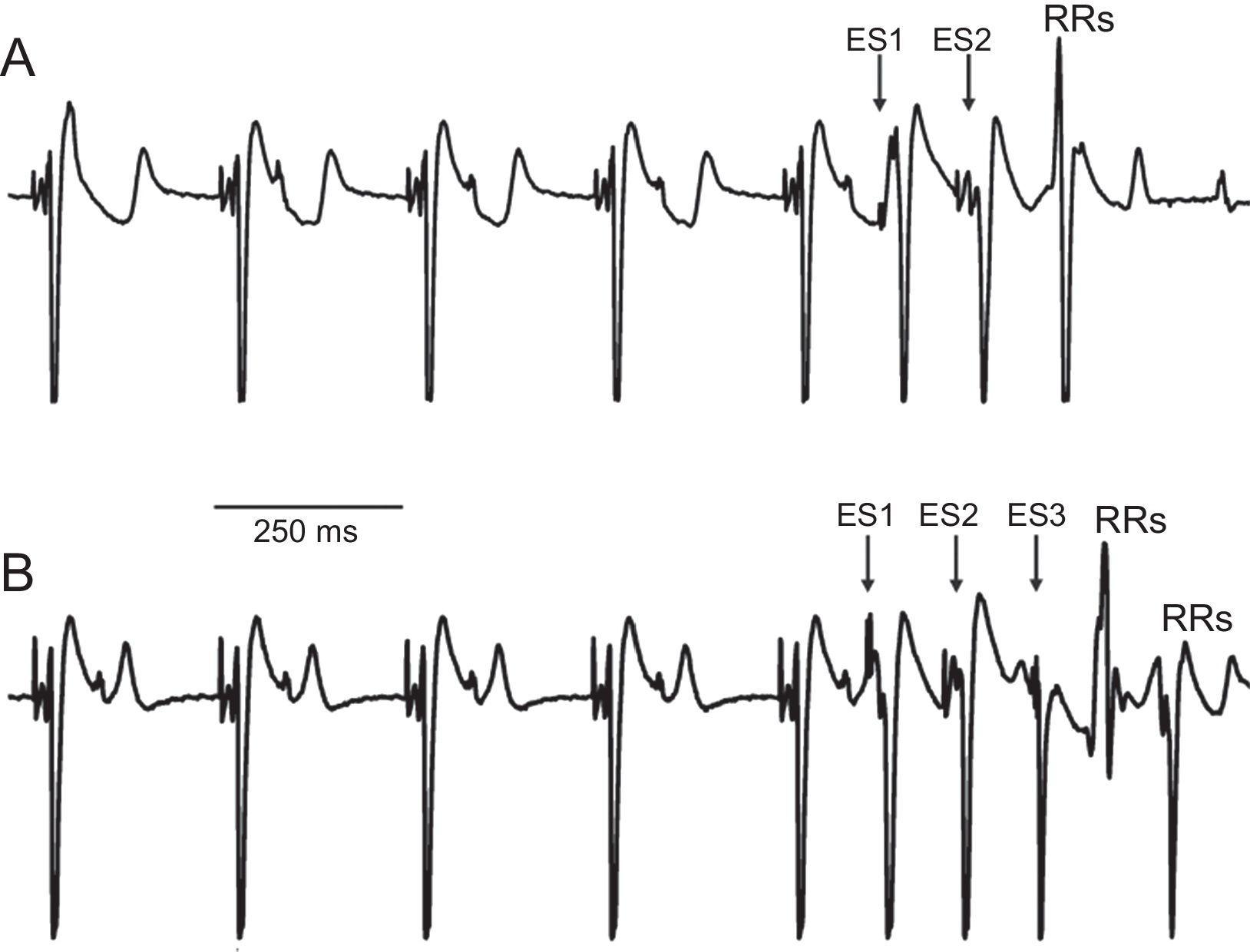 QT Interval Heterogeneities Induced Through Local Epicardial Warming ...