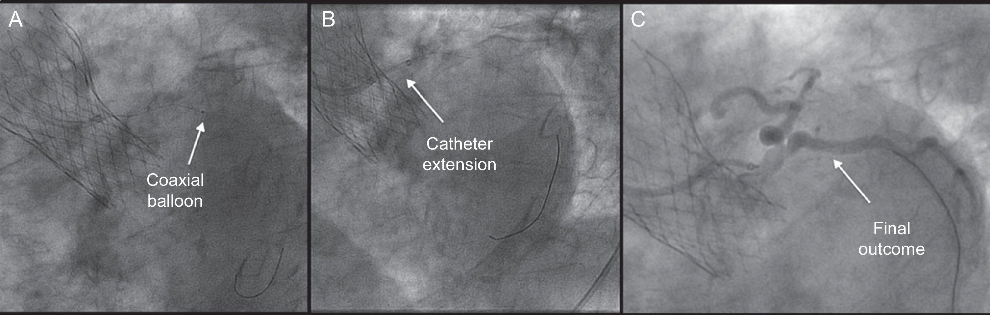 Coronary Angioplasty With Catheter Extension Following Transcatheter ...