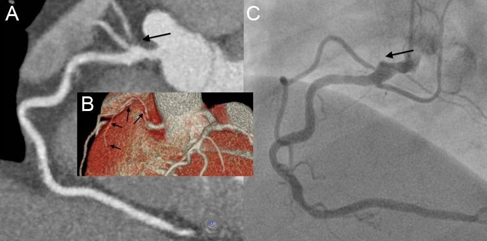 Acute Coronary Syndrome Due to Occlusion of the Conus Artery | Revista ...