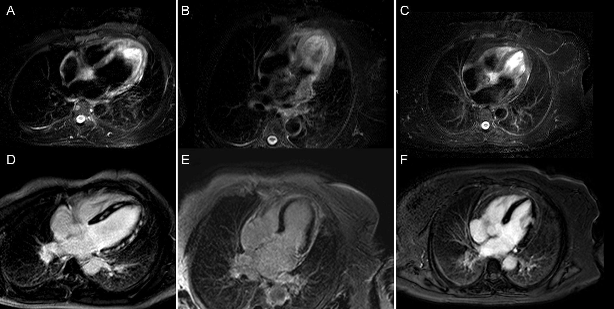 Imaging Techniques in Acute Heart Failure | Revista Española de Cardiología