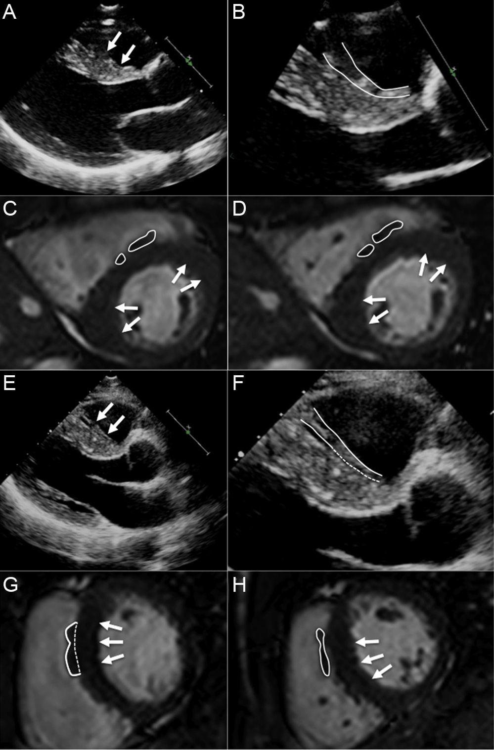 Little-known Aspects in Hypertrophic Cardiomyopathy | Revista Española ...