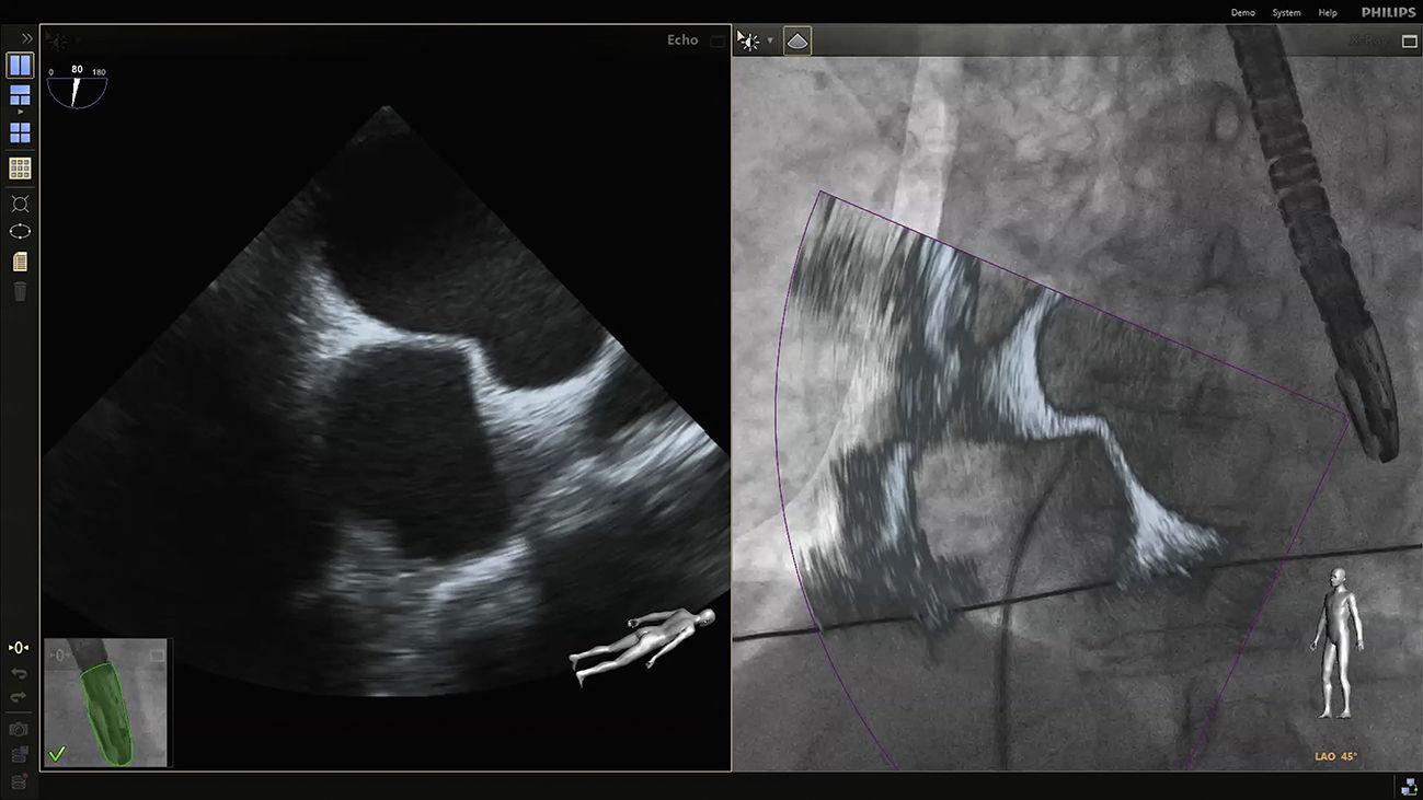 Eco-X Ray Fusion for Transseptal Puncture | Revista Española de Cardiología