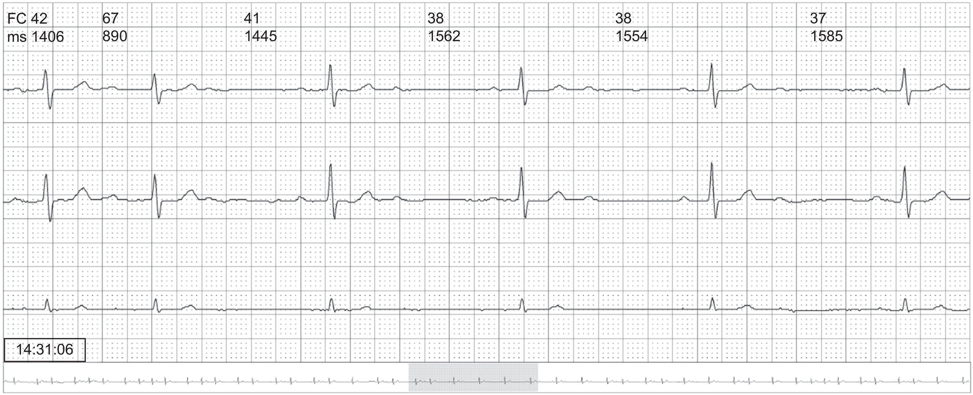ECG, August 2015 | Revista Española de Cardiología