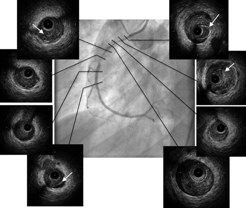 A Spontaneous Coronary Dissection Successfully Treated With ...