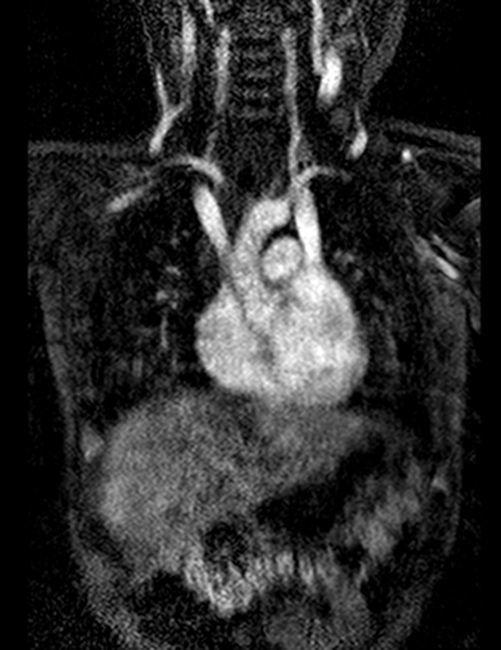 Raghib Syndrome. Surgical Treatment | Revista Española de Cardiología
