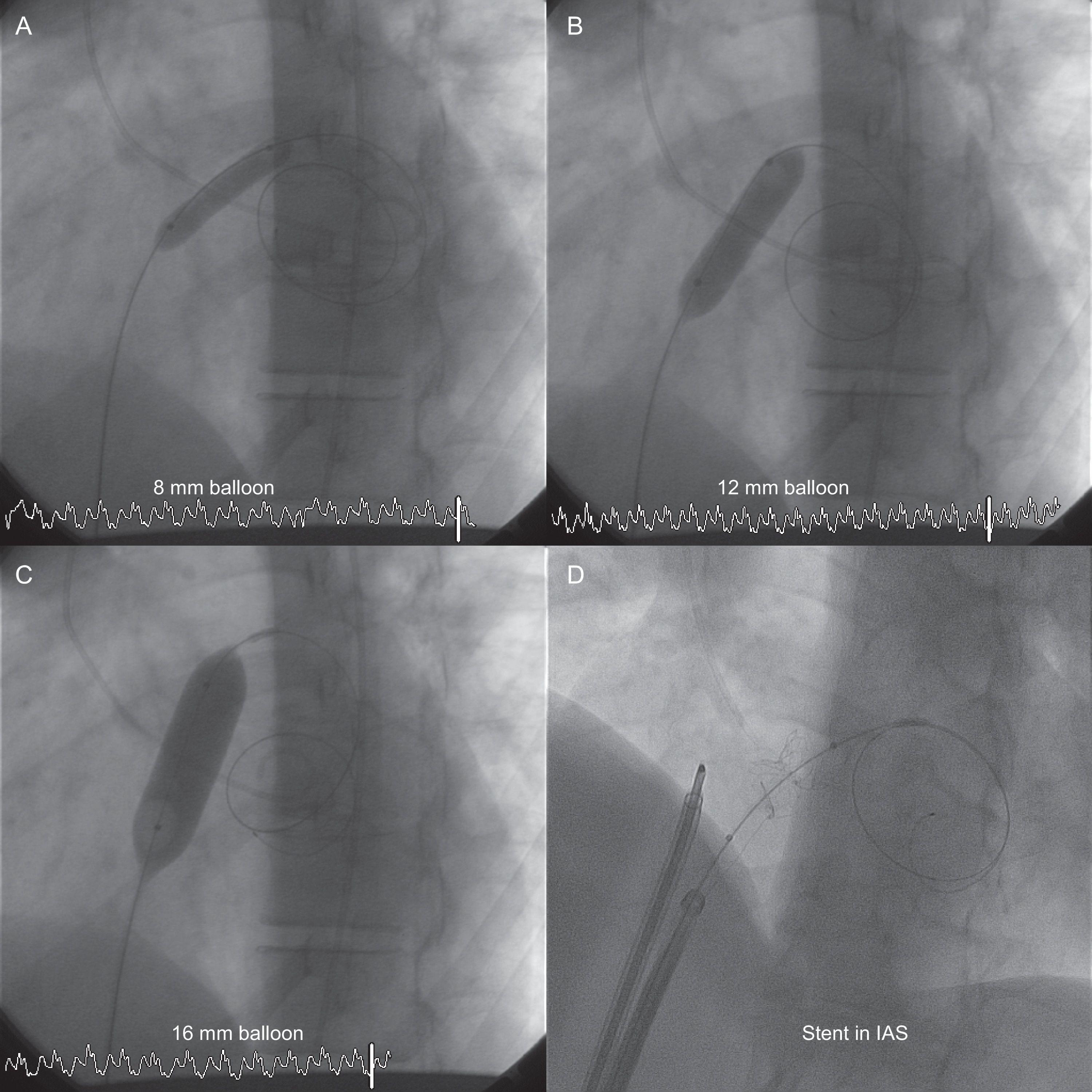 Use of Atrial Septostomy to Treat Severe Pulmonary Arterial ...