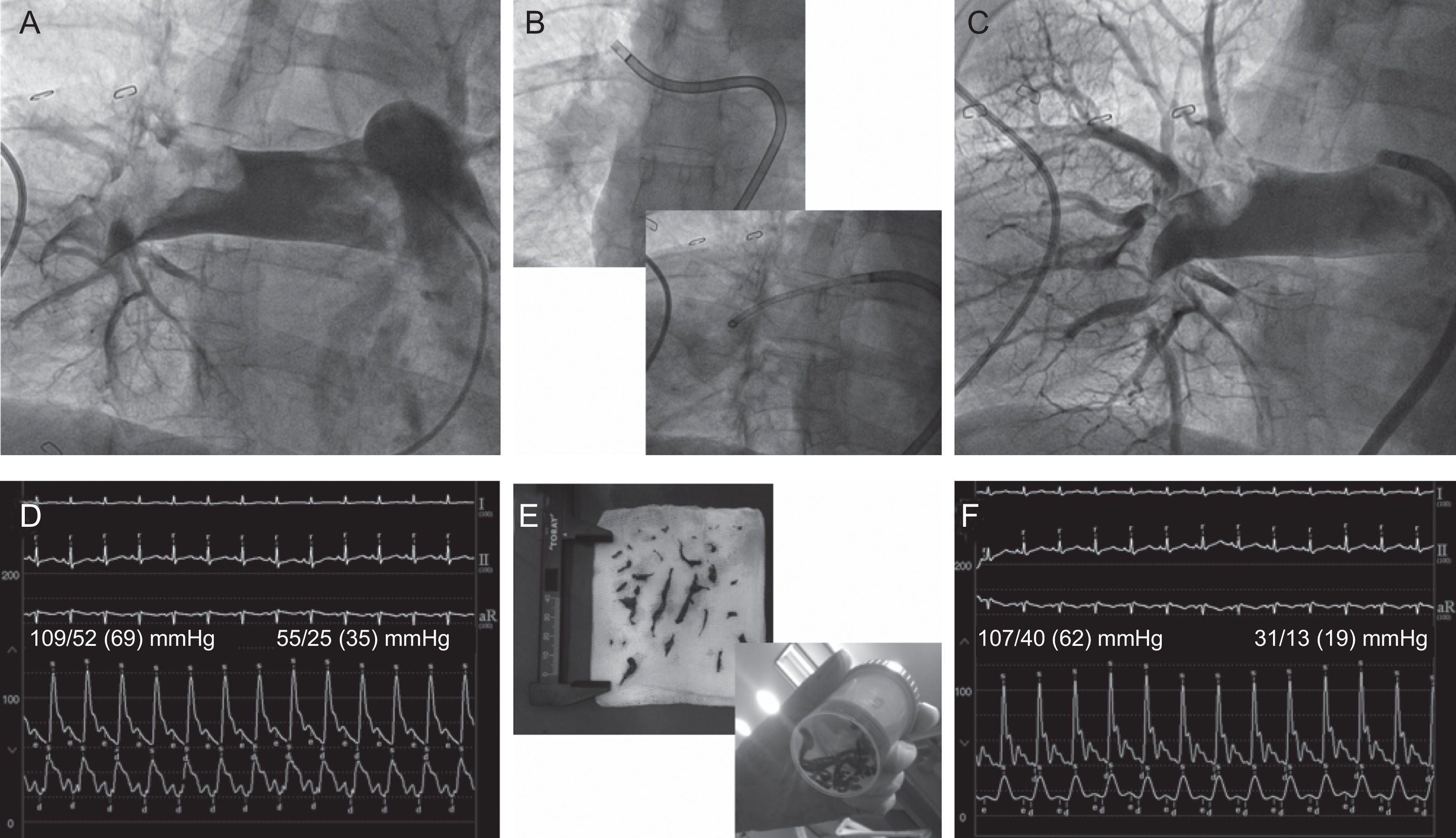Percutaneous Transcatheter Treatment for Massive Pulmonary Embolism ...