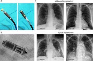 Implantation of the Micra Transcatheter Pacing System: Initial ...