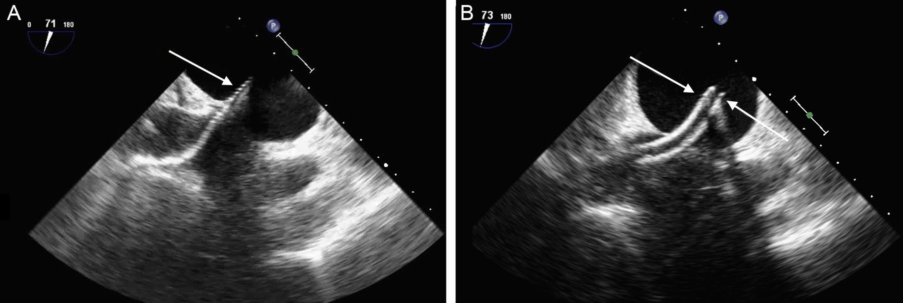 Role of Imaging Techniques in Percutaneous Treatment of Mitral ...