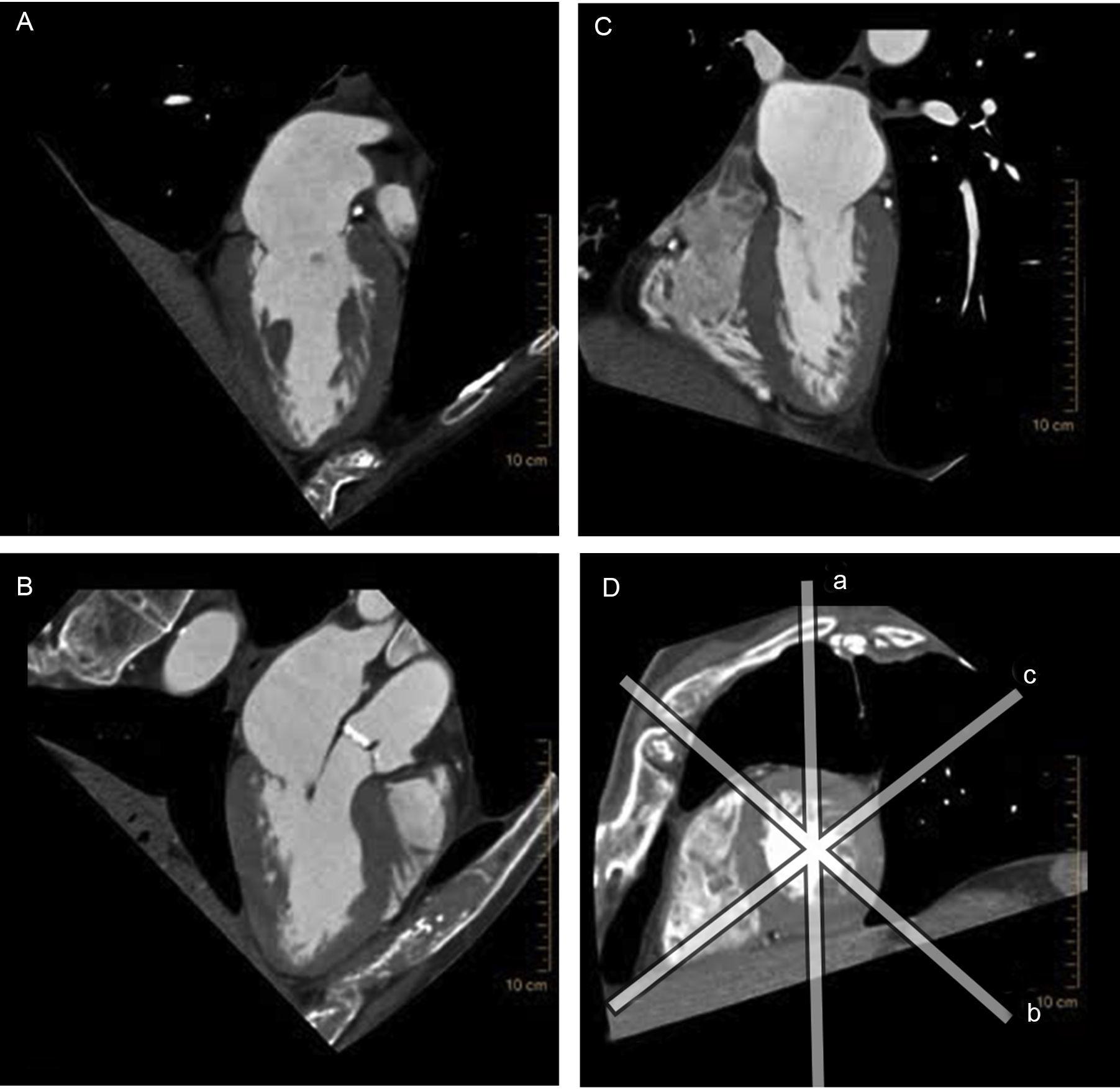 Role of Imaging Techniques in Percutaneous Treatment of Mitral ...