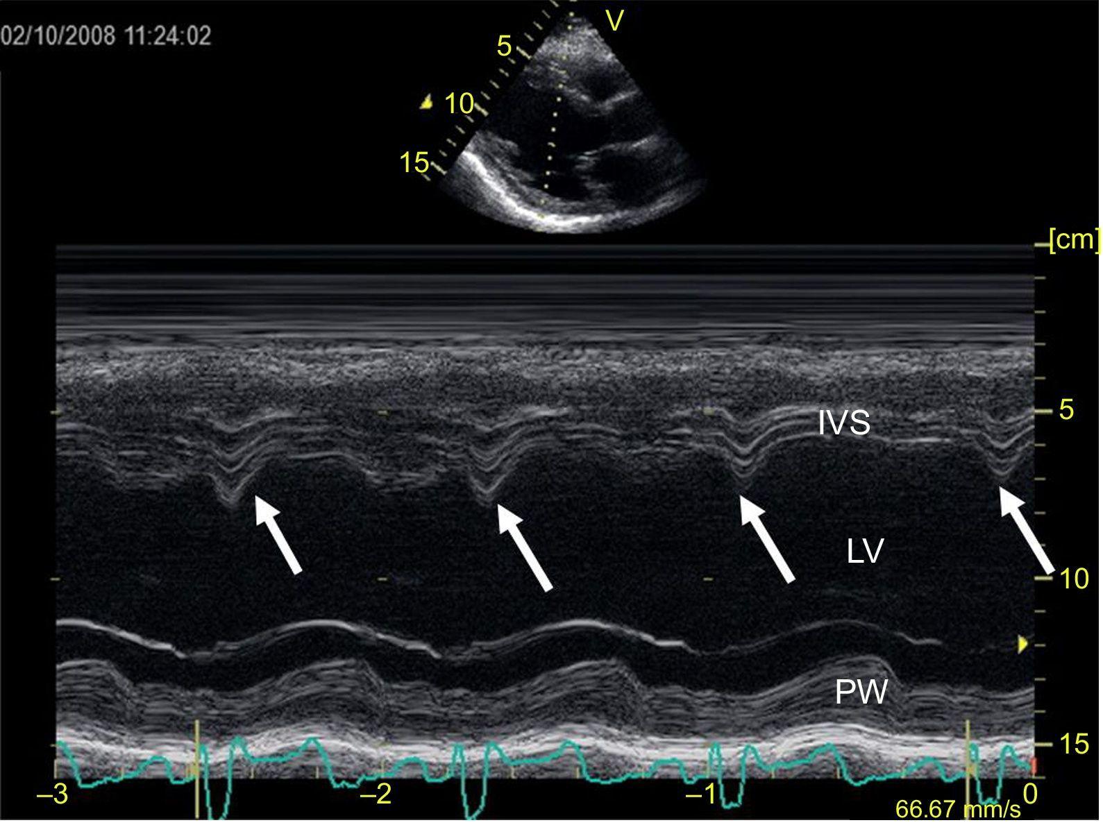 Cardiovascular Imaging in the Electrophysiology Laboratory | Revista ...