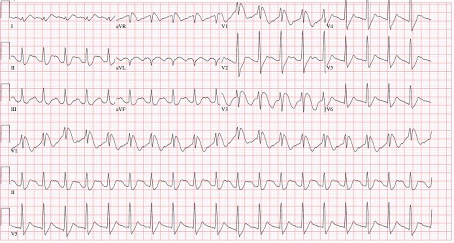 Intermittent Brugada Pattern in Relation to Changes in Body Temperature ...