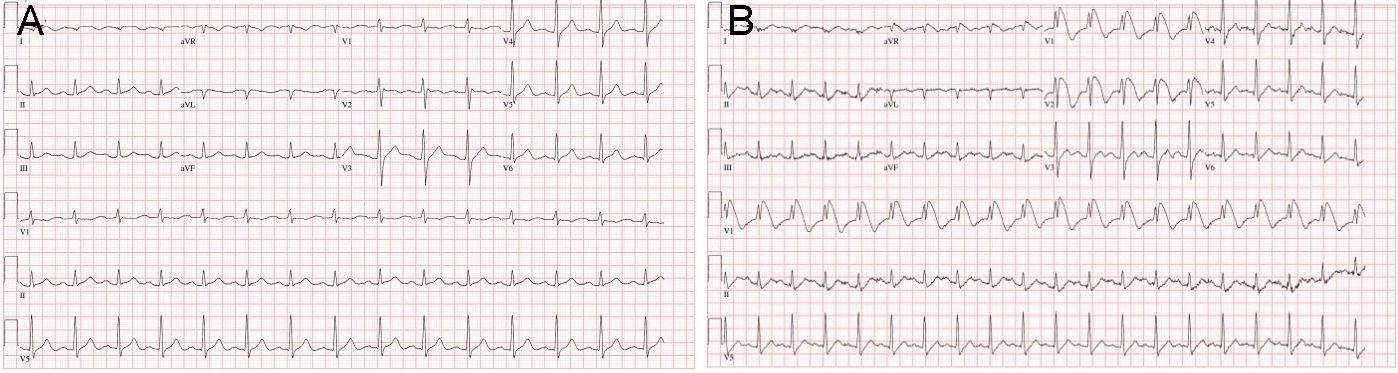 Intermittent Brugada Pattern in Relation to Changes in Body Temperature ...