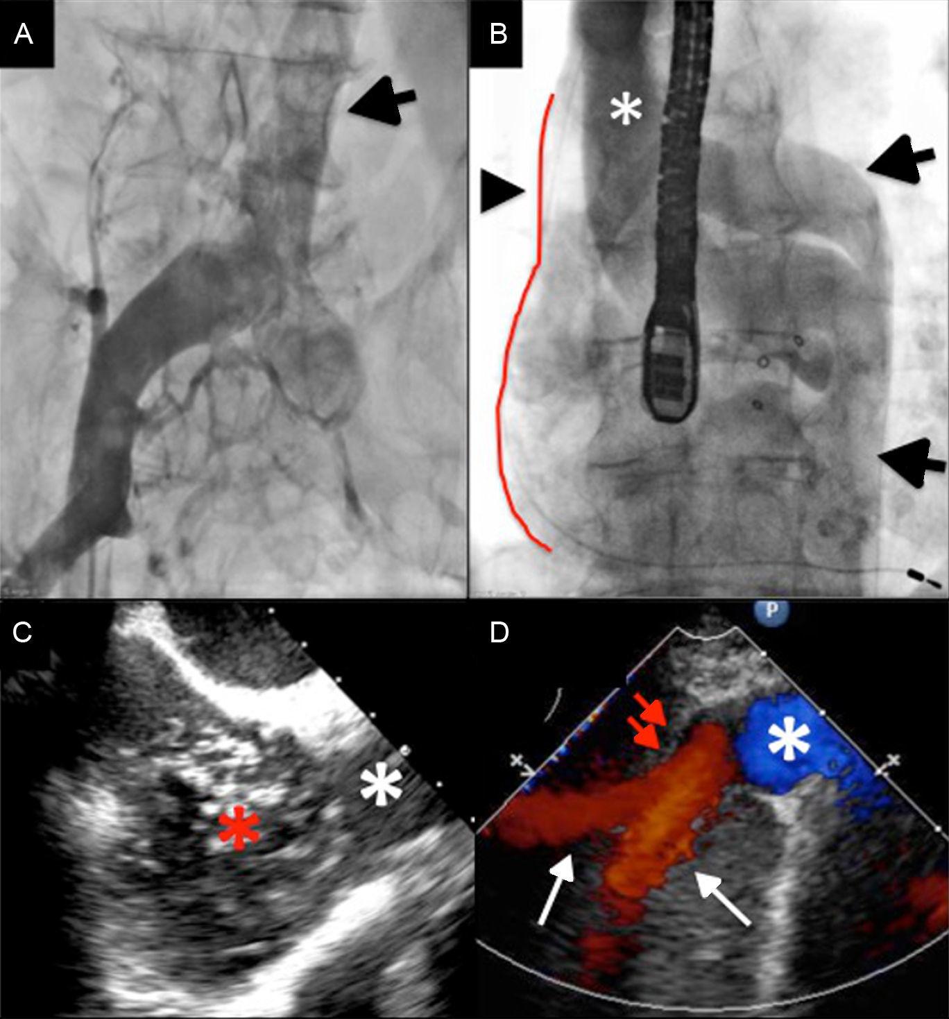 Unexpected Interrupted Inferior Vena Cava Diagnosed During Failed ...