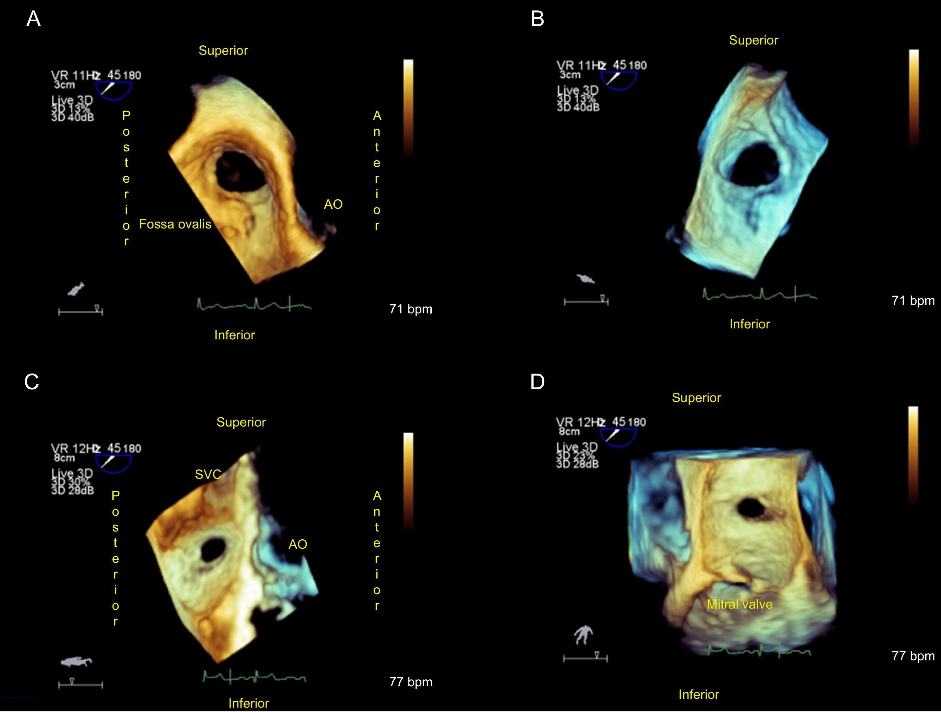 Imaging Techniques in Percutaneous Cardiac Structural Interventions ...