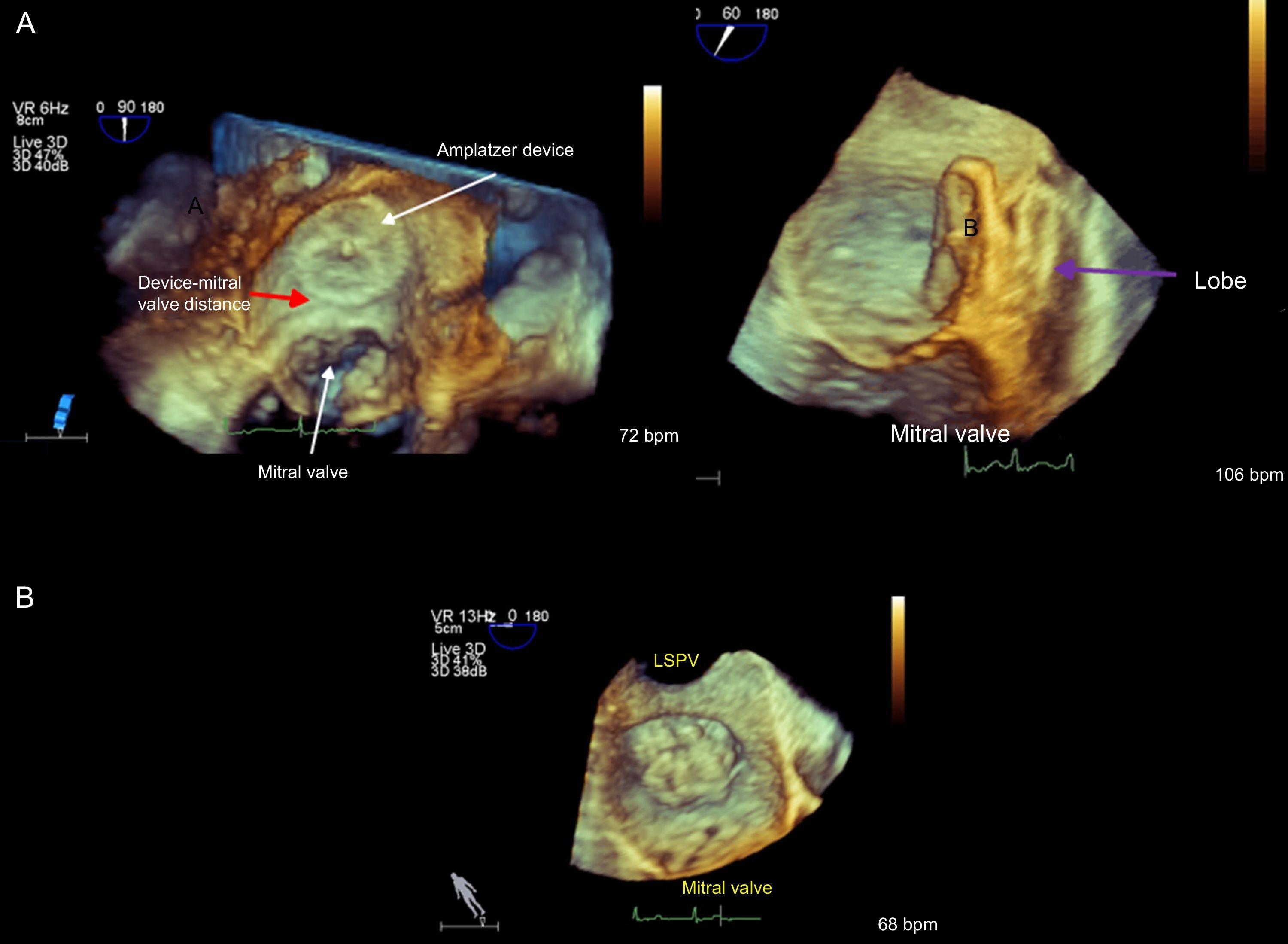 Imaging Techniques in Percutaneous Cardiac Structural Interventions ...