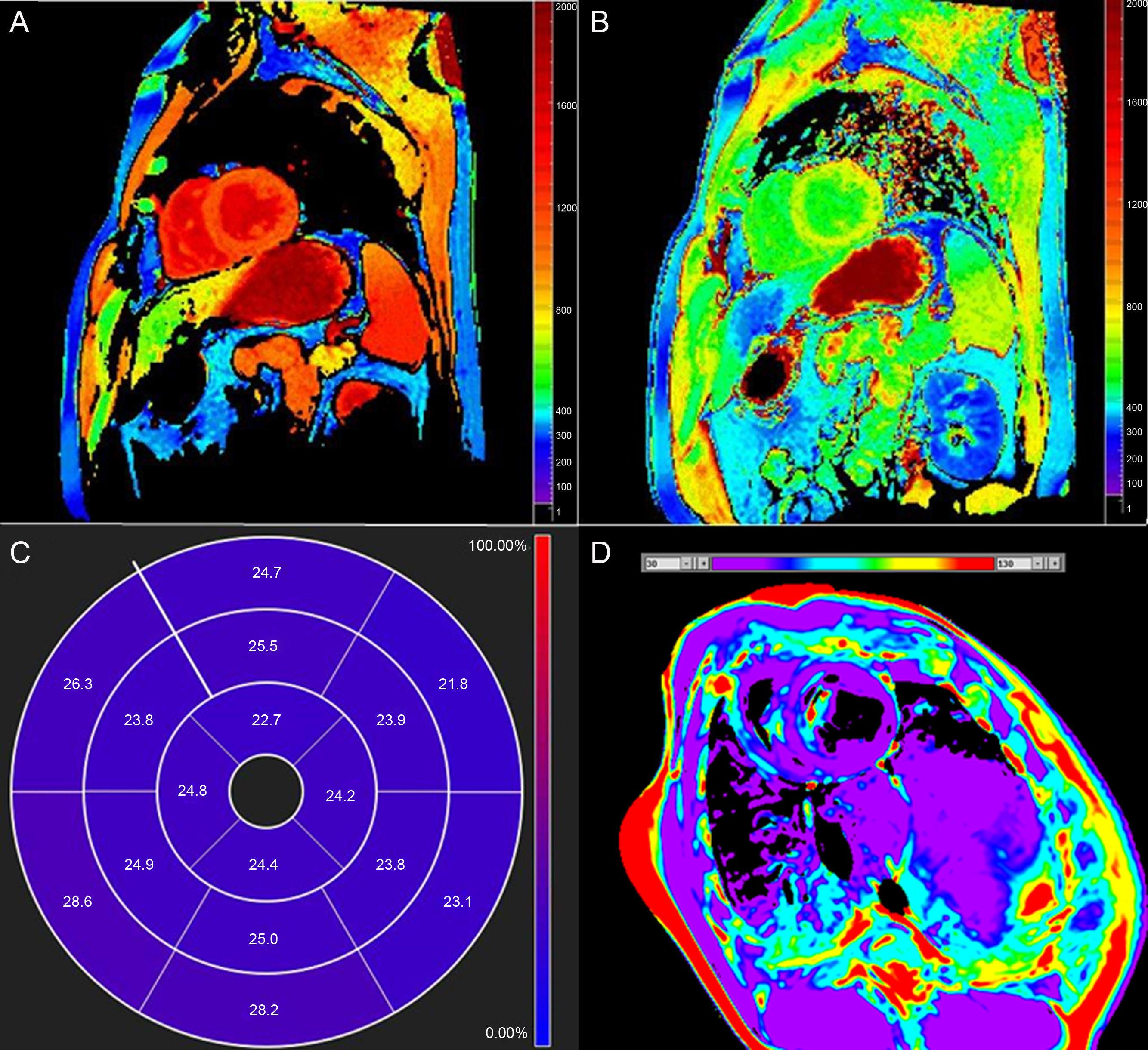 Myocardial Mapping With Cardiac Magnetic Resonance: The Diagnostic ...
