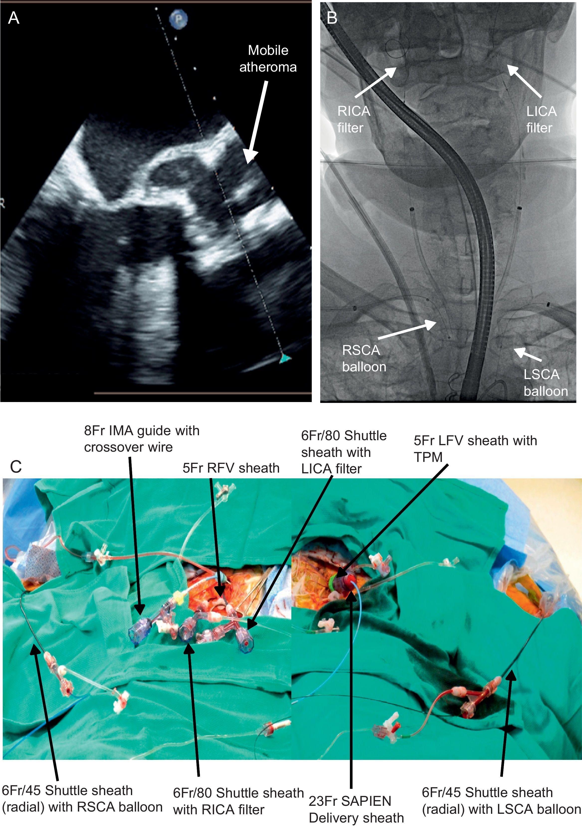 Should Embolic Protection Become the Standard of Care for Stroke ...