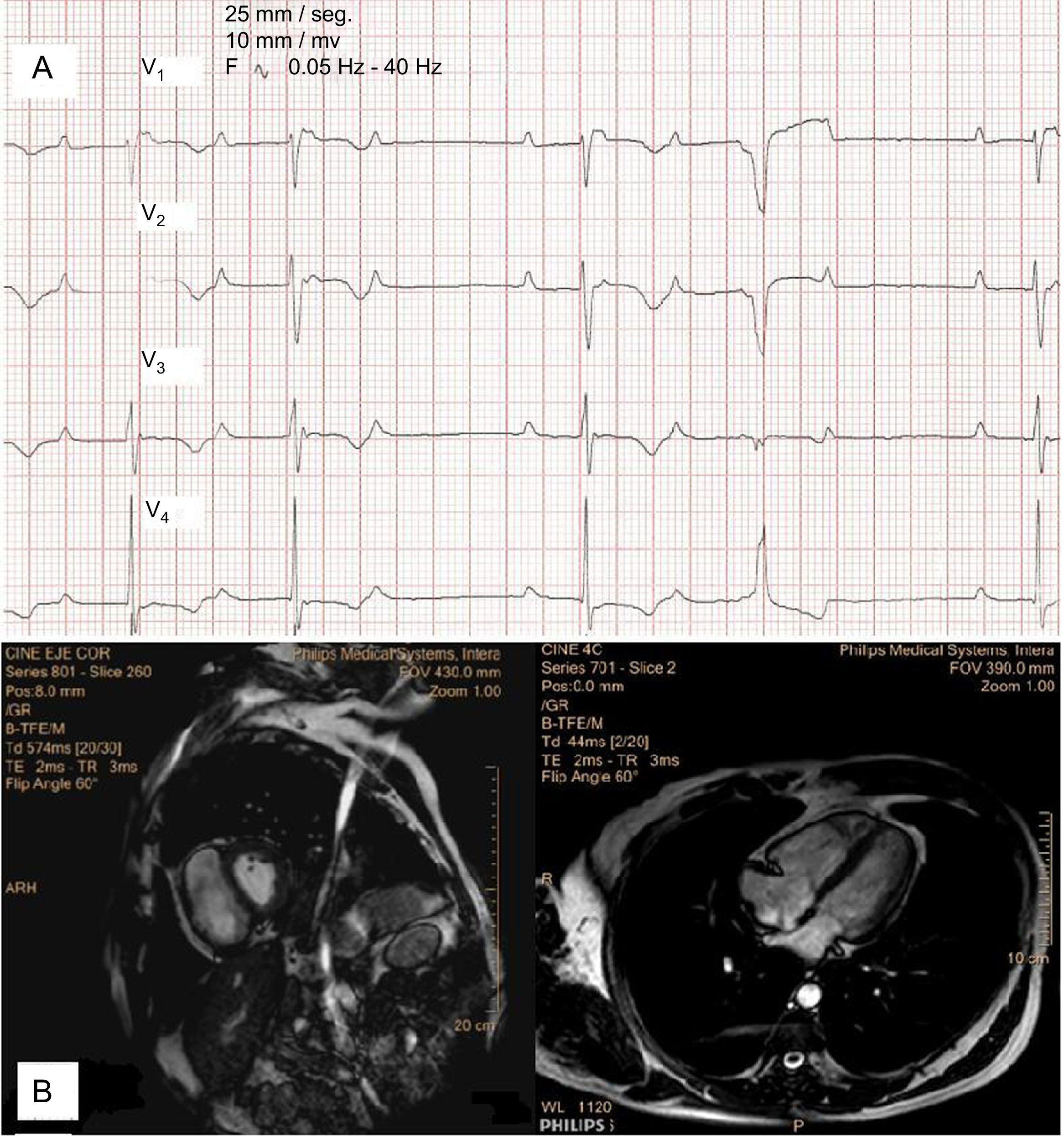 Atrioventricular Conduction Disorder as a First Manifestation of ...