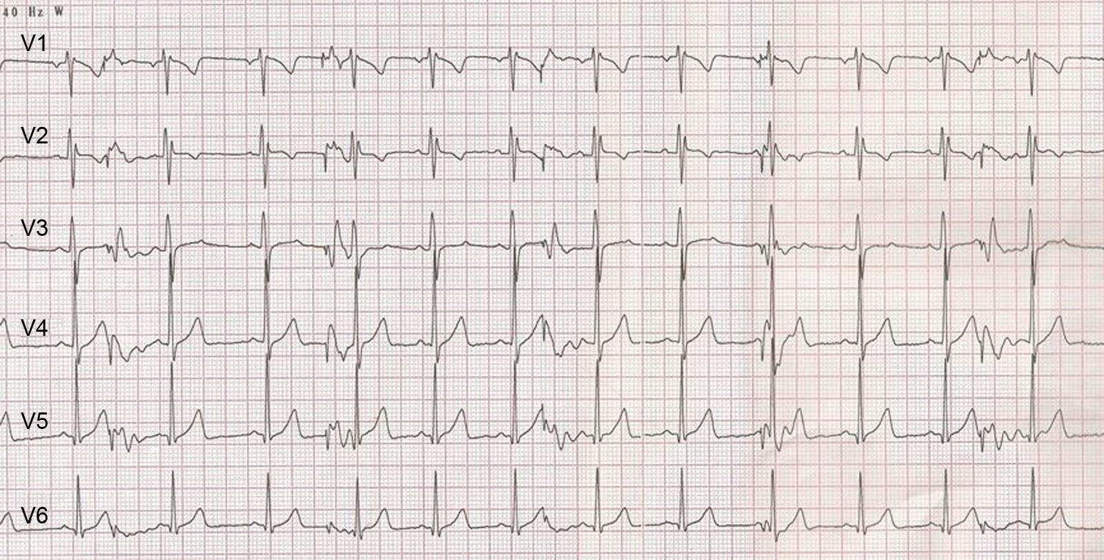 ECG, December 2016 | Revista Española de Cardiología