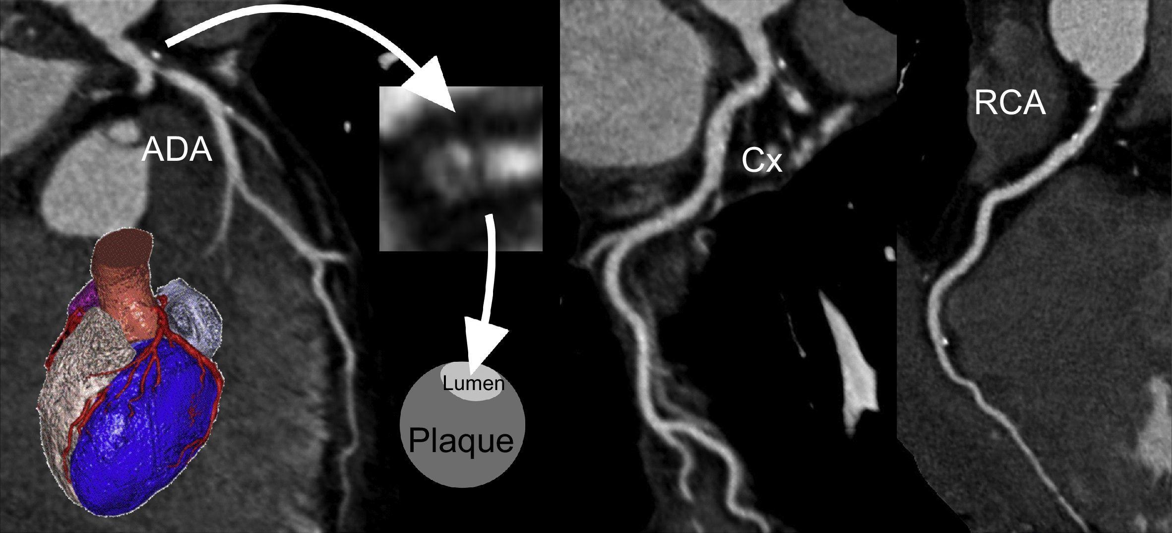 Selection of the Best of 2016 in Cardiac Computed Tomography | Revista ...