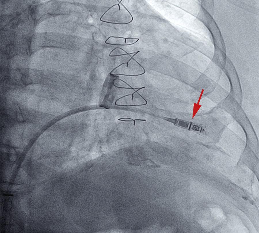 The Micra Leadless Transcatheter Pacemaker. Implantation and Mid-term ...