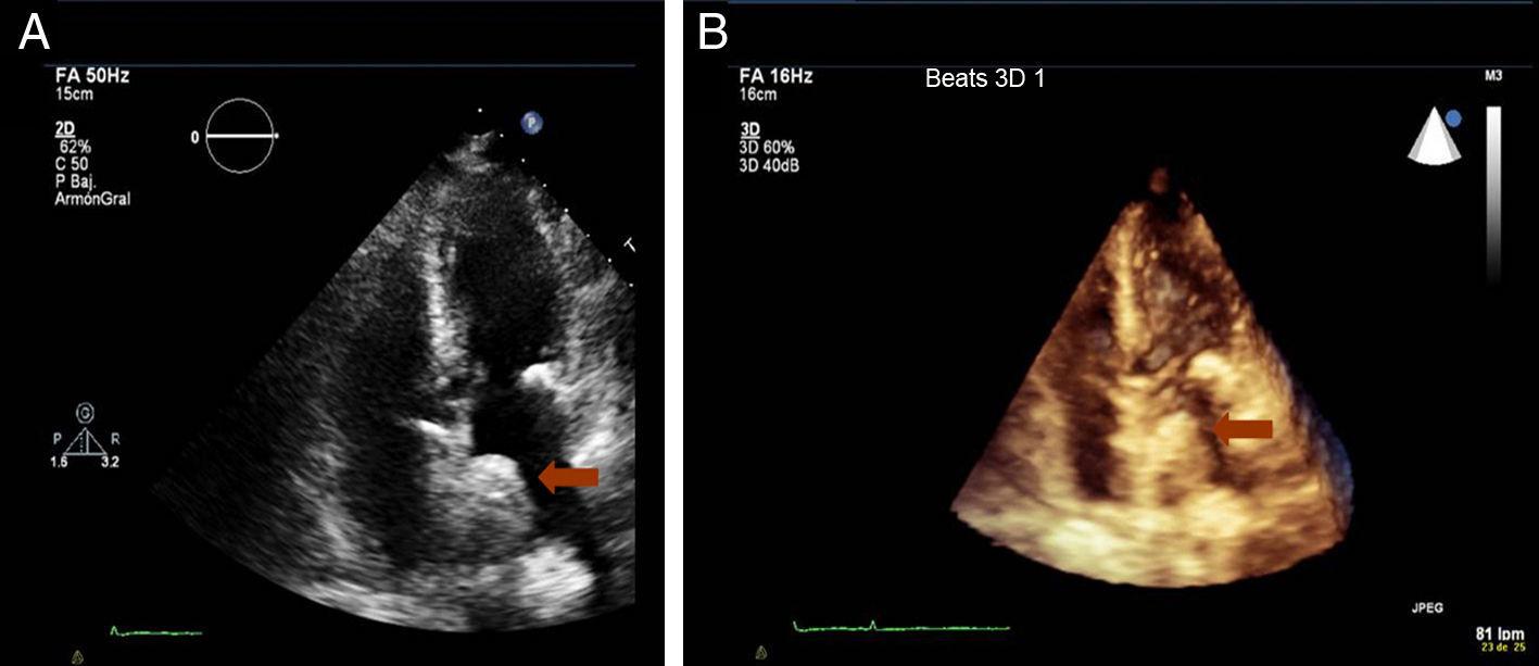 Calcified Left Atrial Myxoma | Revista Española de Cardiología
